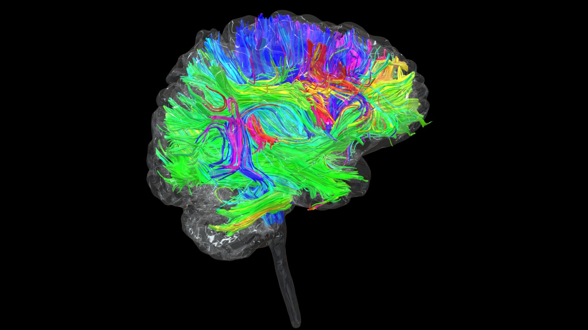 Tractography and Brain from MRI - 3D model by Tecdes SA (@tecdessa ...