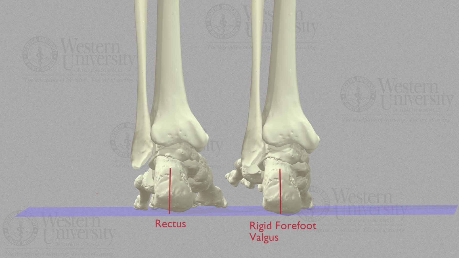 Rigid Forefoot Valgus - 3D model by WesternU3D [e31db49] - Sketchfab