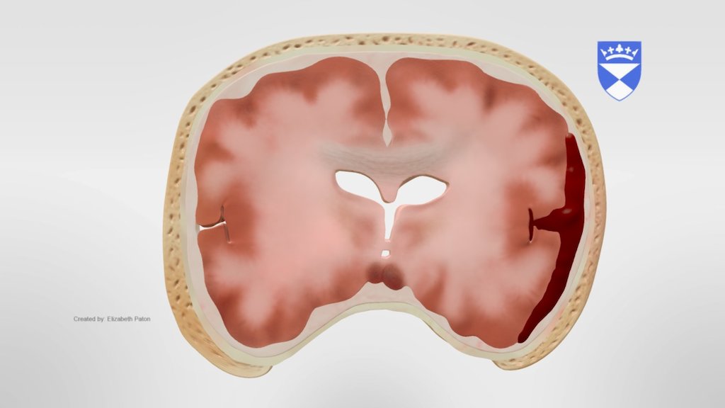 Subdural Haematoma - Download Free 3D model by Liz Paton ...