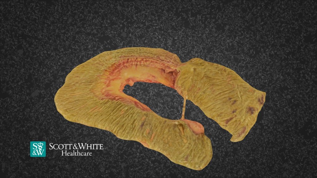 Ileum Ileitis 152086 - 3D model by Scott & White Moulage Project ...