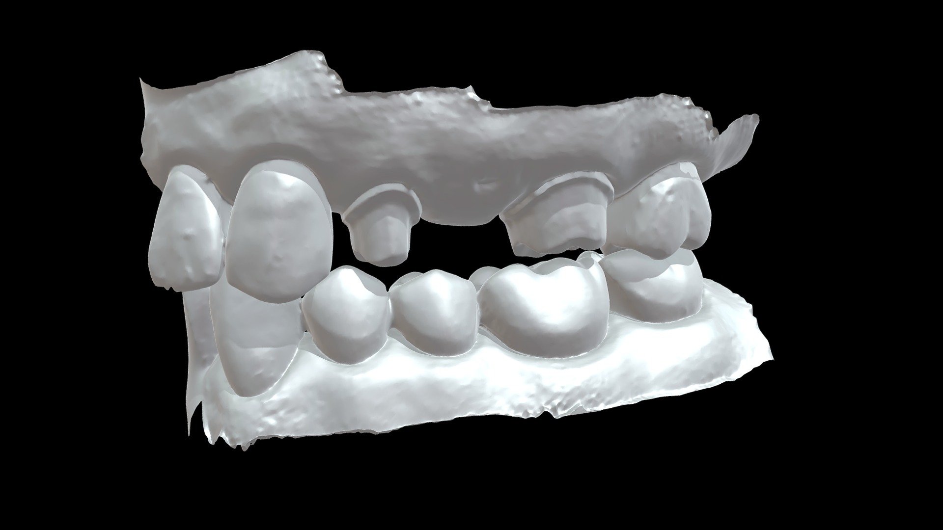 #12-14 FPD Preparation Articulated - Download Free 3D model by bchui ...