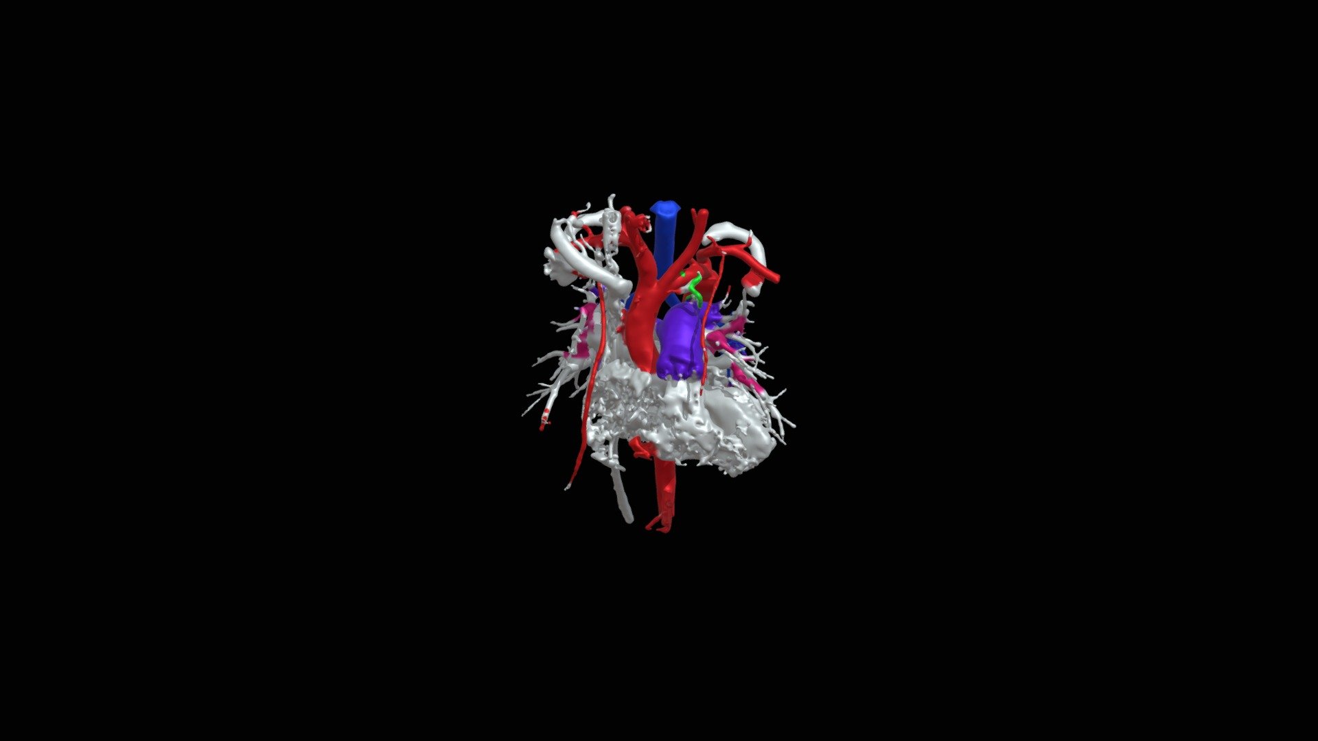 Coarc with hypoplastic arch - Download Free 3D model by jonbra [e3f27f3 ...