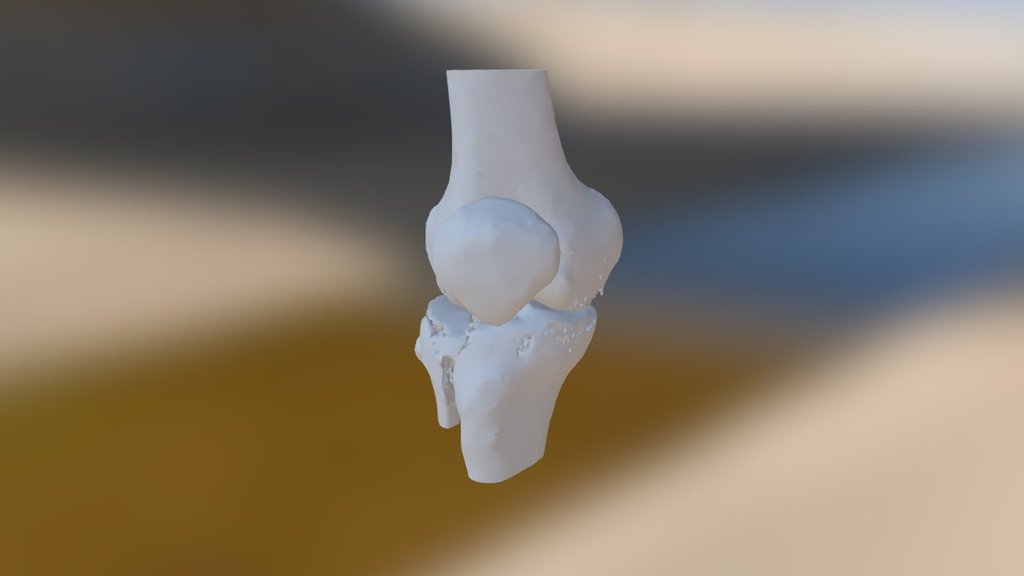 Knee - Proximal Tibia Fracture sku 042 - 3D model by orto3d [e44aeb0 ...