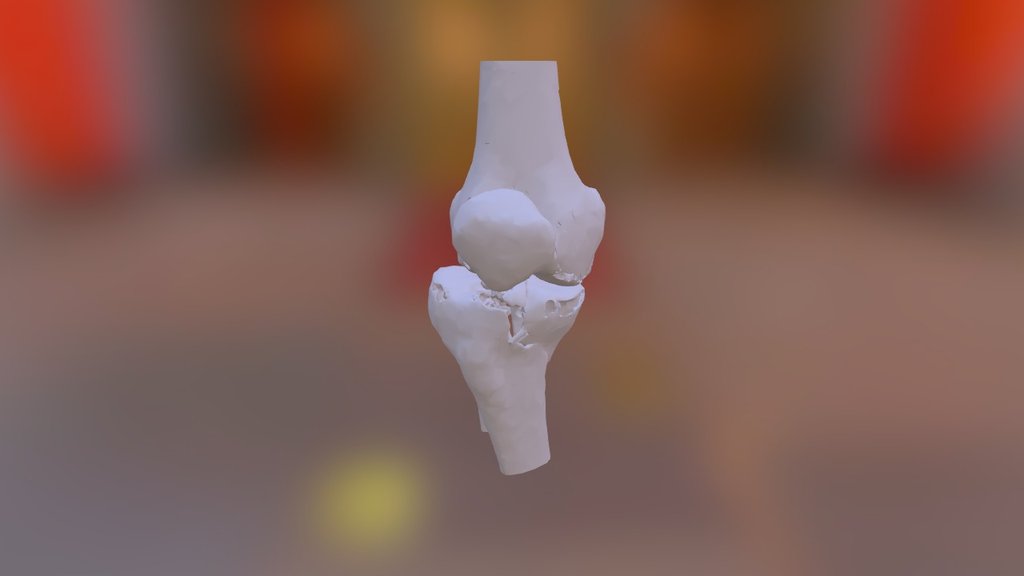 Knee - Proximal Tibia Fracture sku 031 - 3D model by orto3d [e4b9cc3 ...