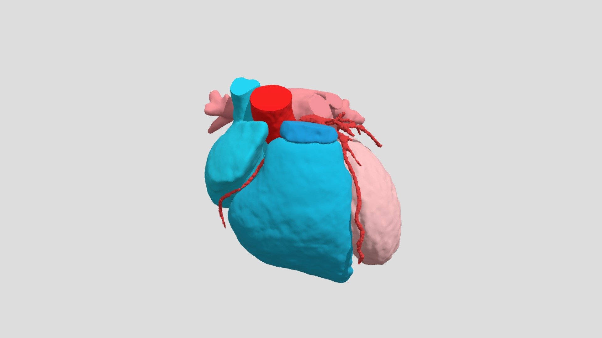 Coronary Artery Aneurysm (S0387) - 3D model by NCHS Cardiac Advanced ...