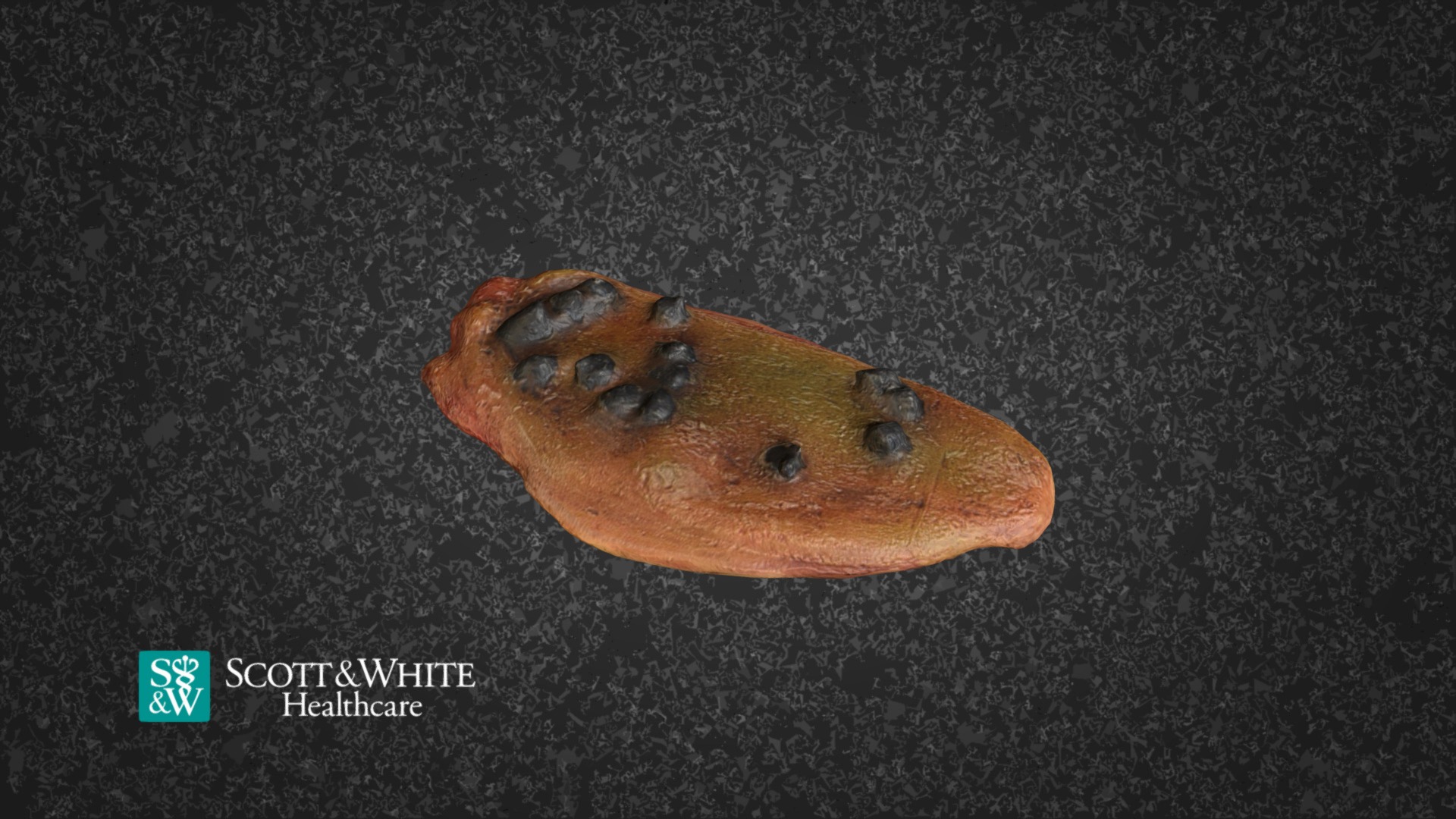 Gallbladder Black Gallstones 52001 - 3D model by Scott & White Moulage ...