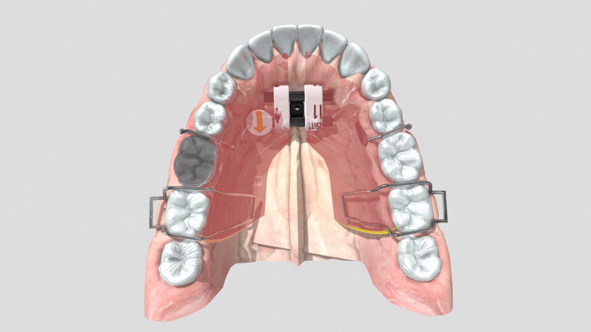 3-removeable-mandibular-expander - 3D model by Holos Studios [e76ca54 ...