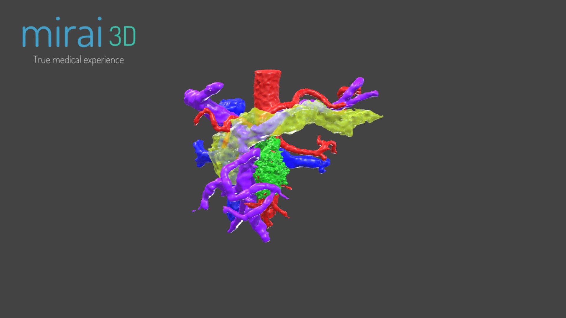 3D anatomical model for pancreatic cancer - 3D model by MIRAI3D ...
