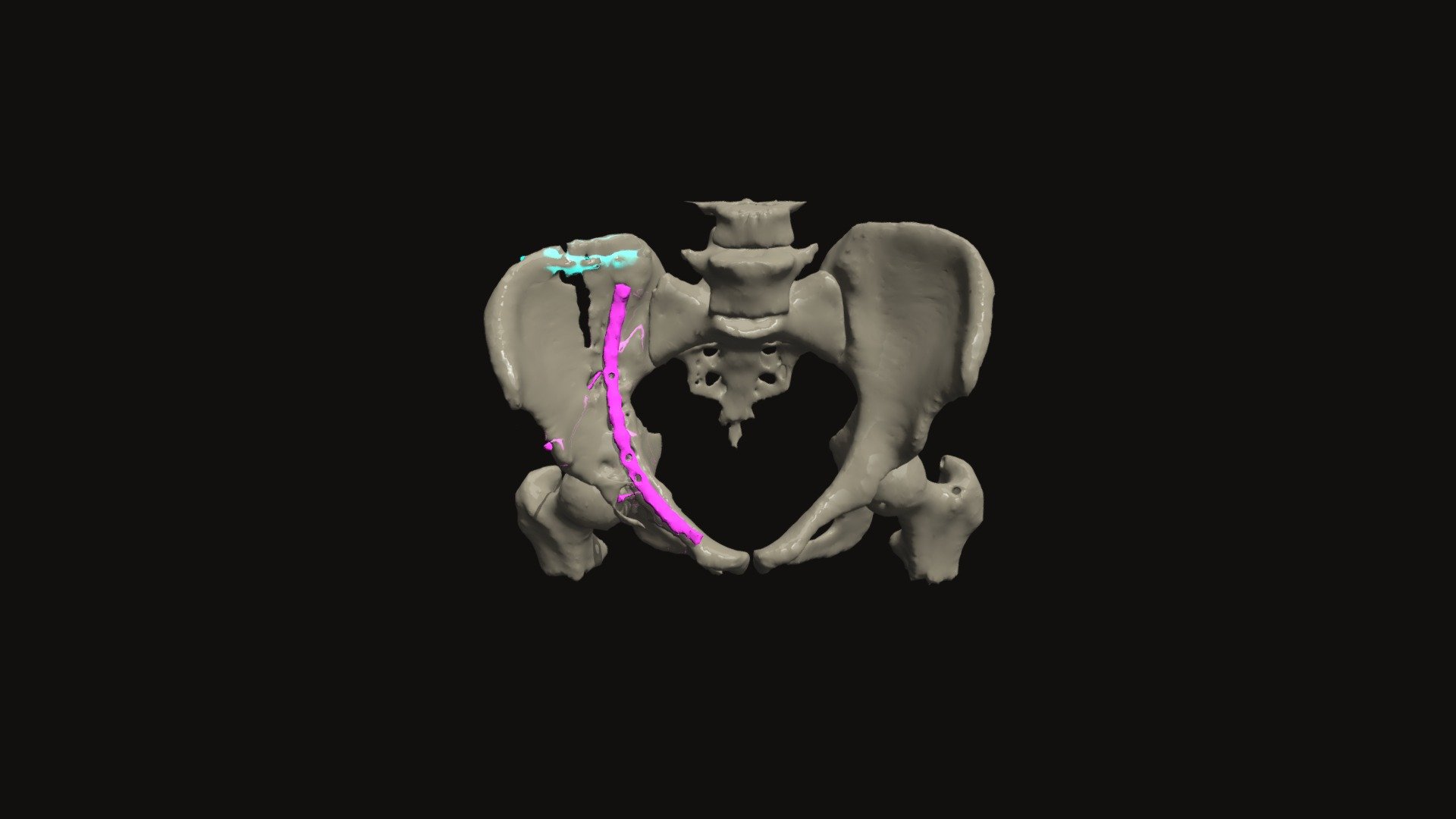 Pelvic Fracture and Implanted Hardware - Download Free 3D model by ...
