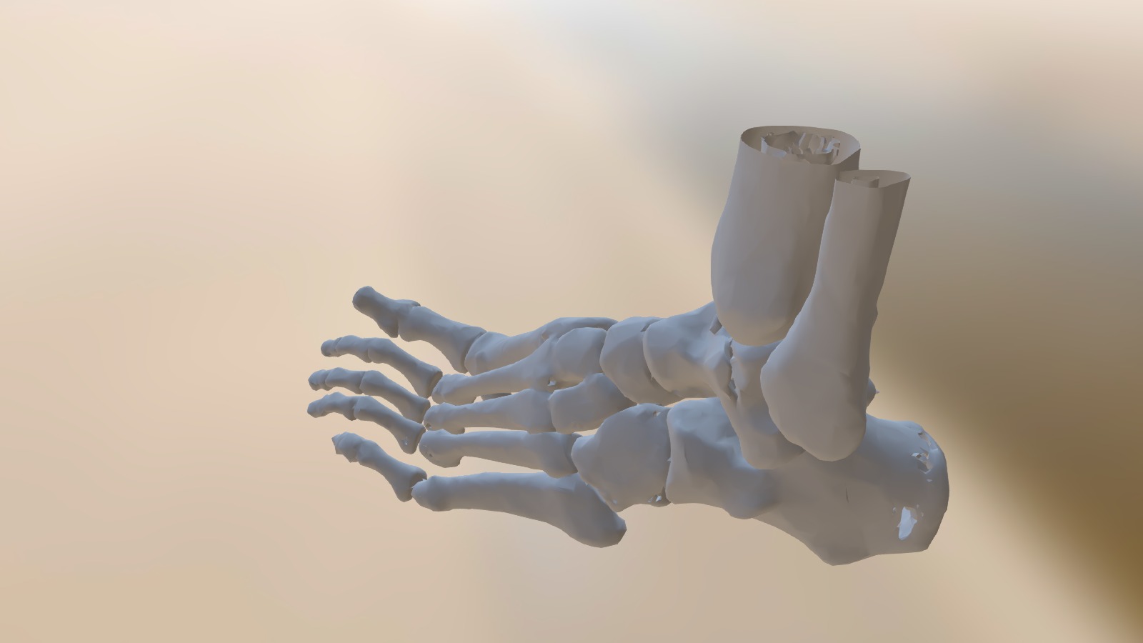 Foot and Ankle - Talus fracture - sku 162 - 3D model by orto3d [e808951 ...
