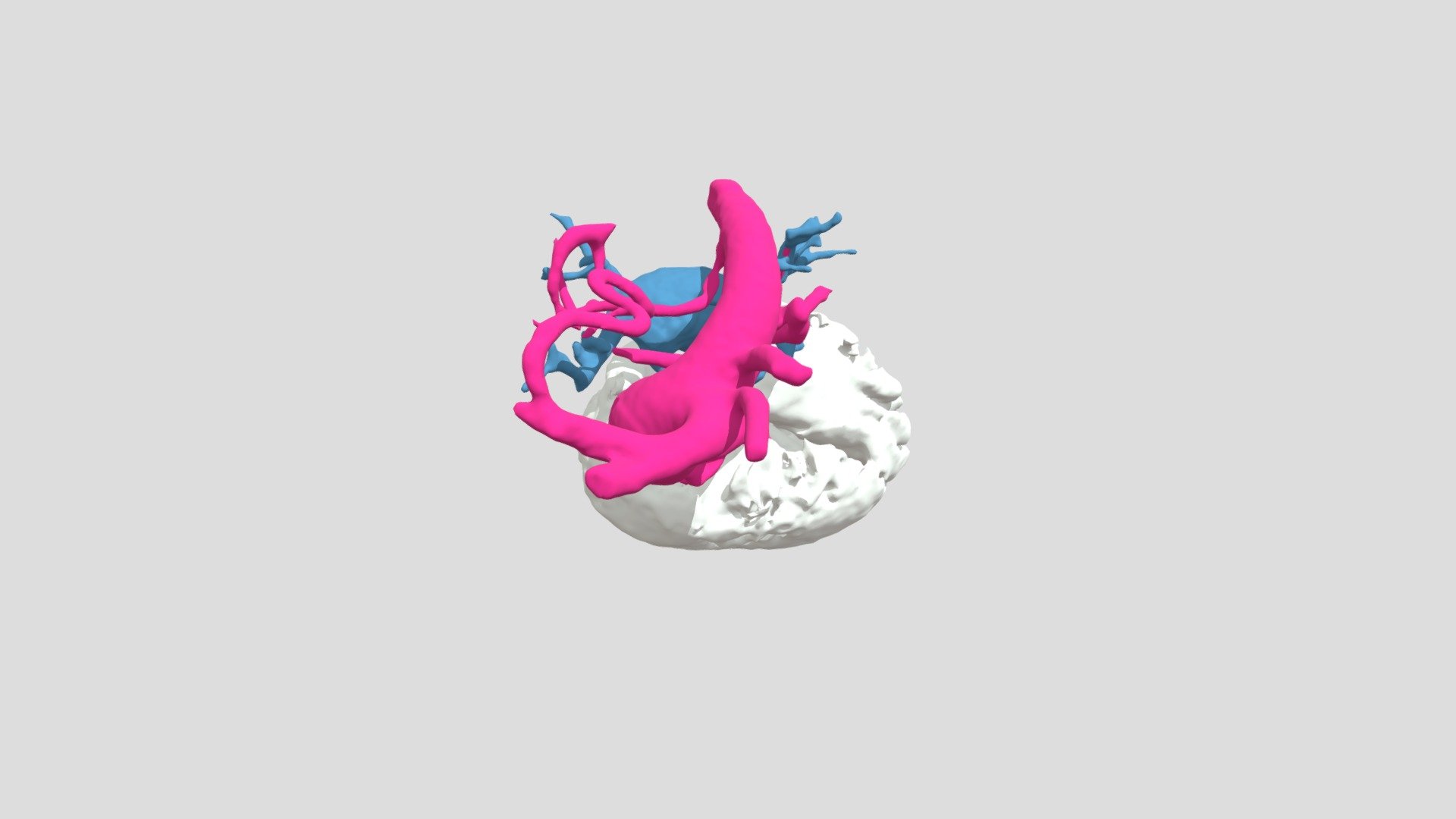 MAPCAS, Pulmonary Atresia, VSD (S0364) - 3D model by NCHS Cardiac ...