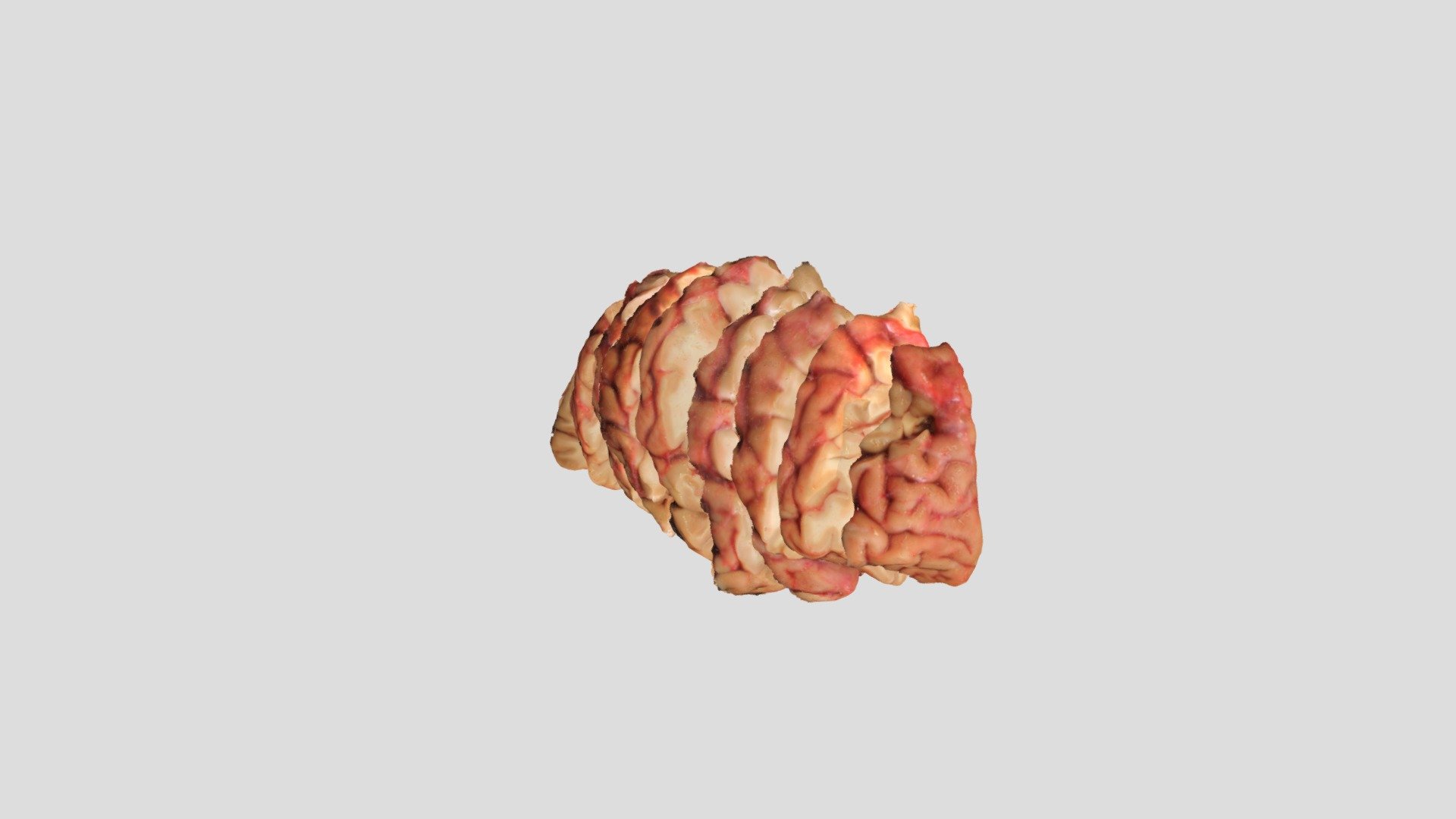 Coronal section of brain with Alzheimer's - 3D model by NeurobancoGNA ...