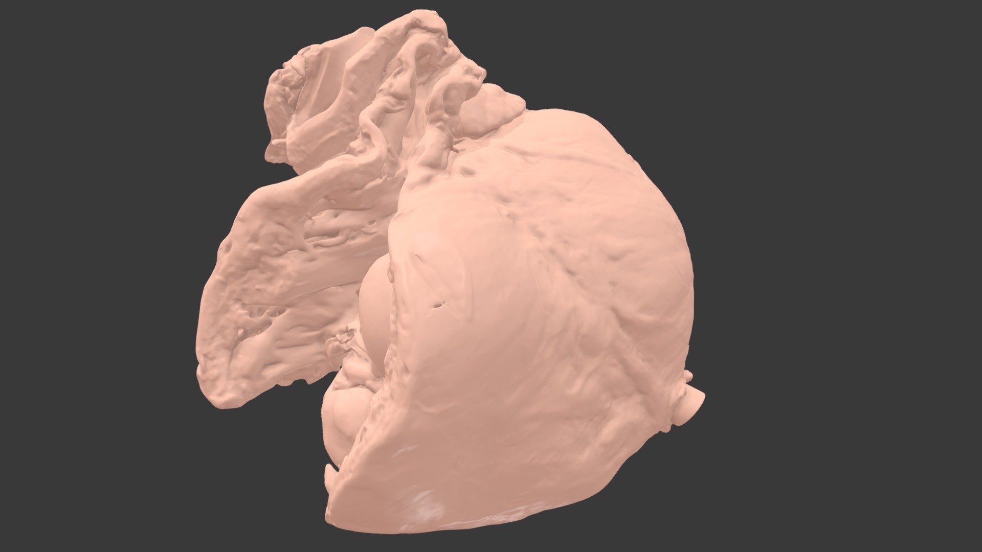 Tumor 1 {s D S} With Rhabdomyoma In The Rv 3d Model By Heartmodels