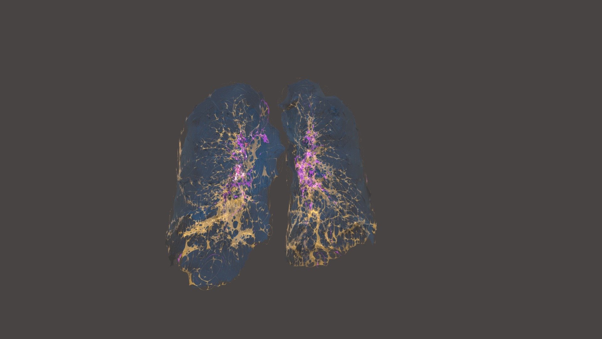 Combined Diseased Lungs - 3D model by iiambahii3 [e8f28aa] - Sketchfab