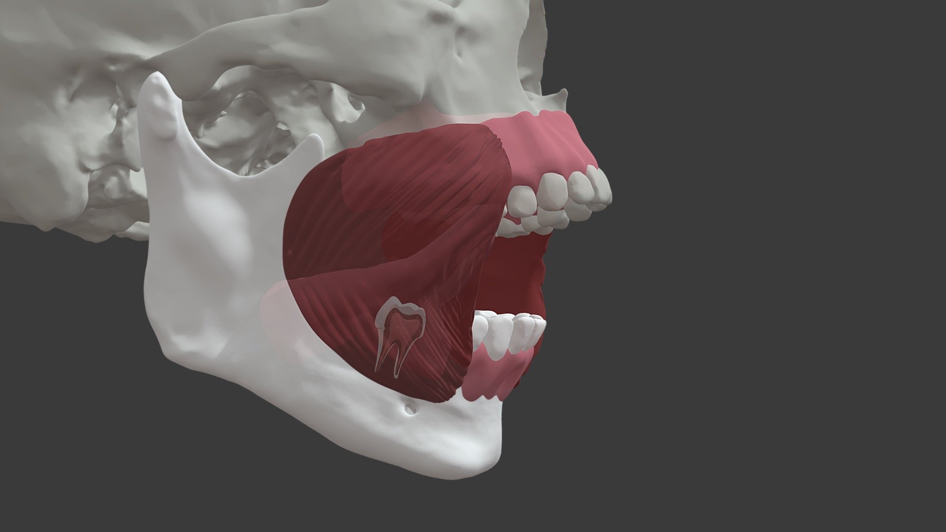 Stage 1- Mandibular Molar Infection Pathway 3 - 3D model by University ...