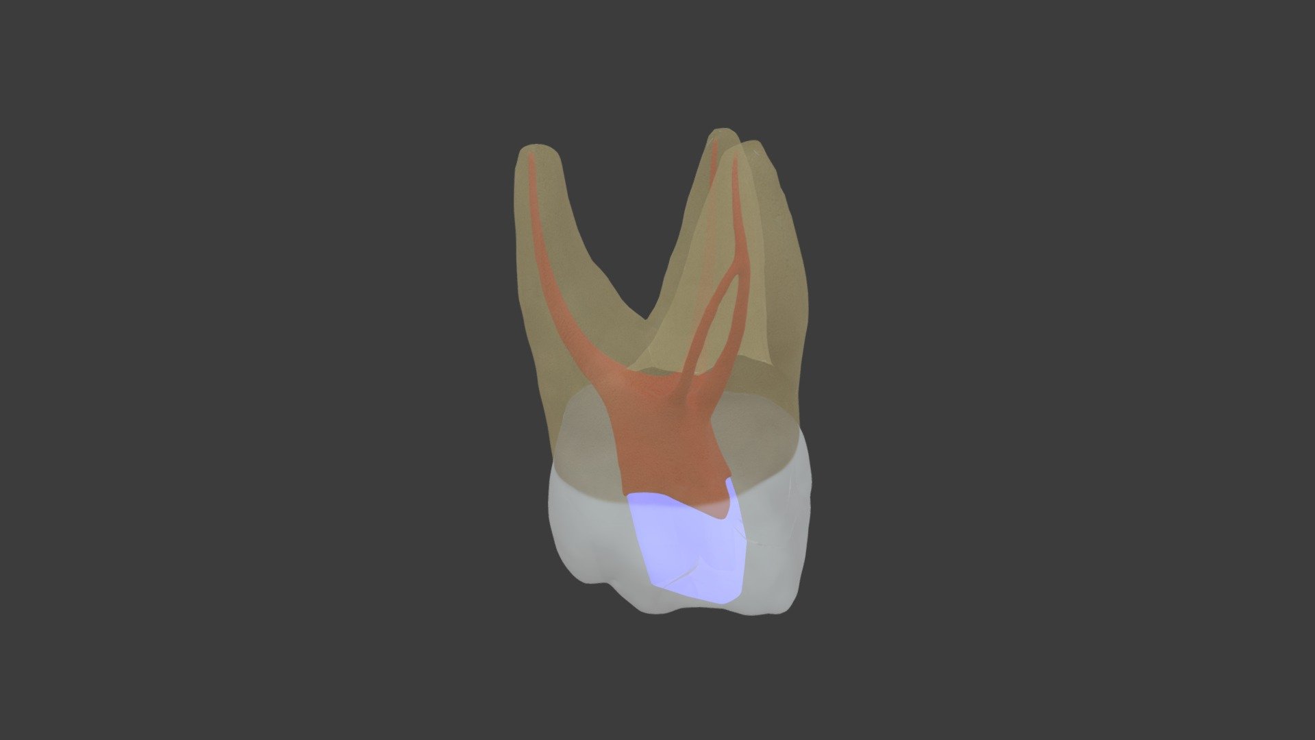 Maxillary First Molar Acess - 3D model by Ahmed Mahrous (@drahedmahrous ...