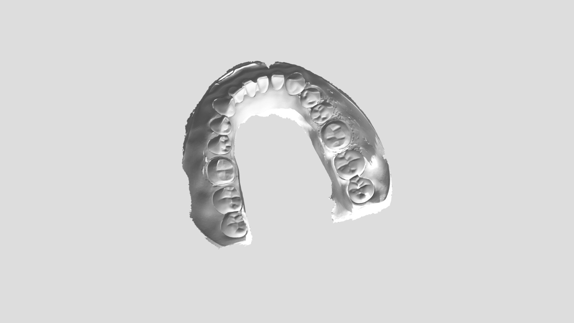 Dr Calderon UDM PFM #19 Quadrant LowerJawScan - 3D model by N.calderon ...