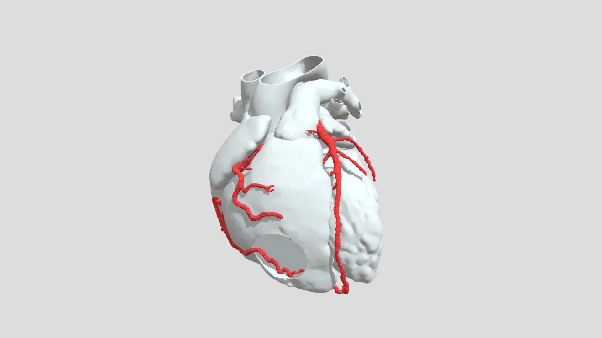 ALCAPA (H0294) - 3D model by NCHS Cardiac Advanced Projects Lab 3D [ea55906] - Sketchfab