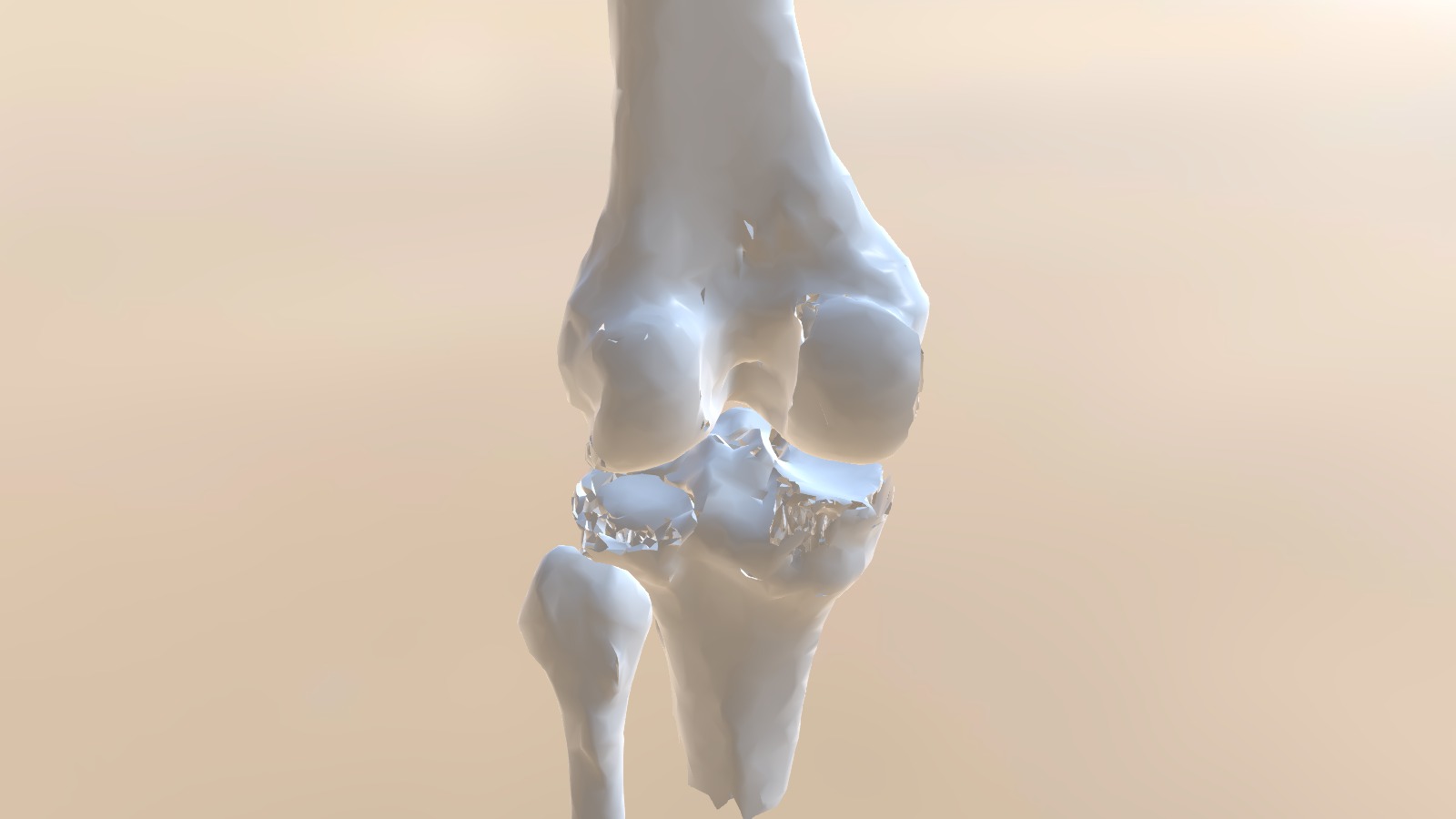 Knee - Proximal Tibia Fracture sku 024 - 3D model by orto3d [ec6bac1 ...