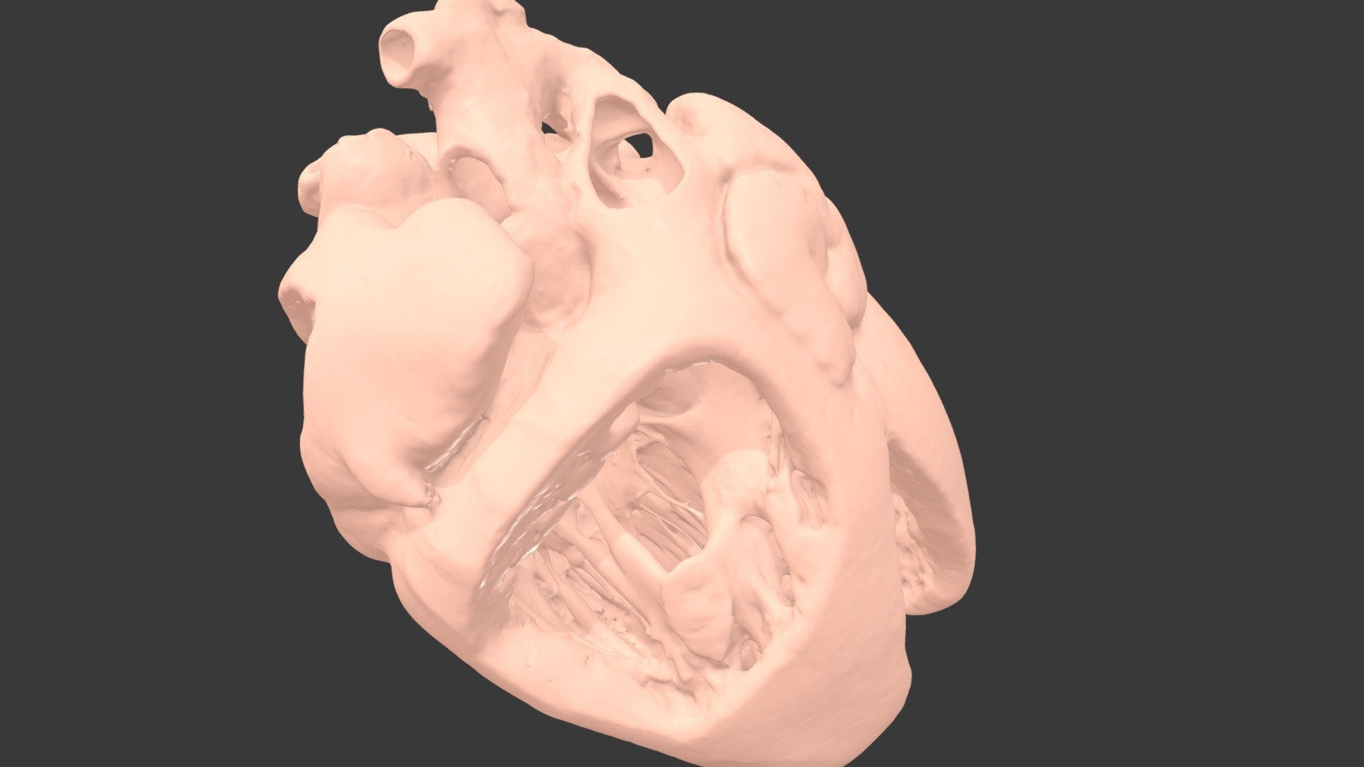 ASD #7 - {S,D,S} with PDA and ASD2 - 3D model by heartmodels [ed03bb2 ...