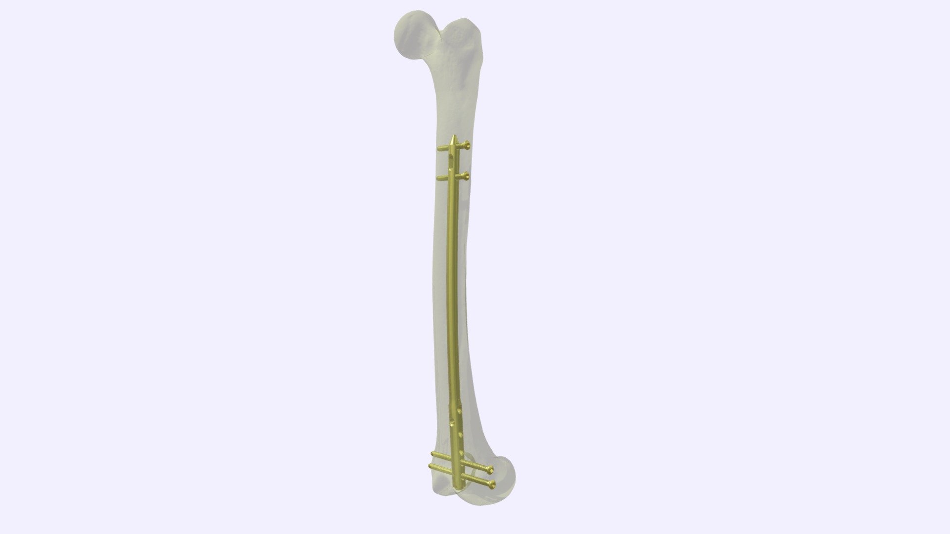 Antegrade/Retrograde Femoral Nail (260-340 mm) - 3D model by OSTEOMED-M ...