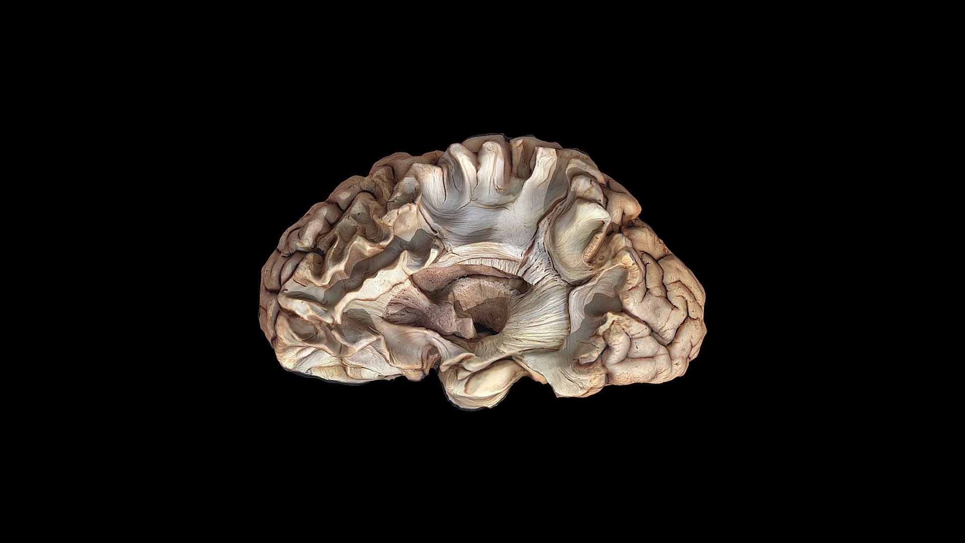 Subthalamic Nucleus - 3D model by Istanbul-Microneurosurgery ...