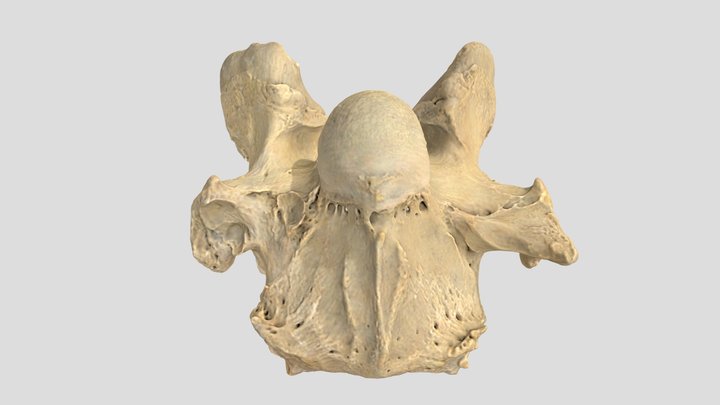 Bifid-rib 3D models - Sketchfab