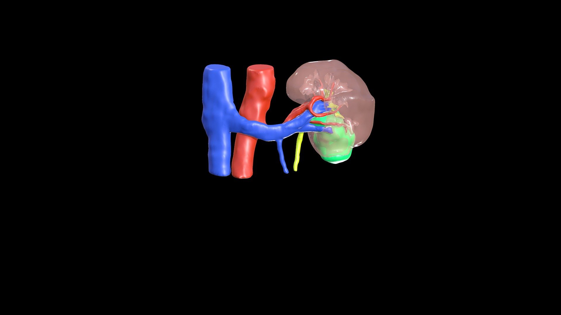 Left Renal Tumor - 3D model by Cirurgic3D (@neorenal) [ef3e251] - Sketchfab