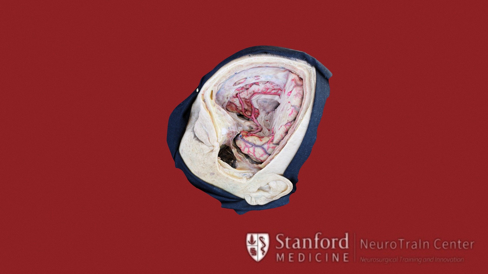 Craniotomy - step 1 - 3D model by vv (@verav) [ef55902] - Sketchfab