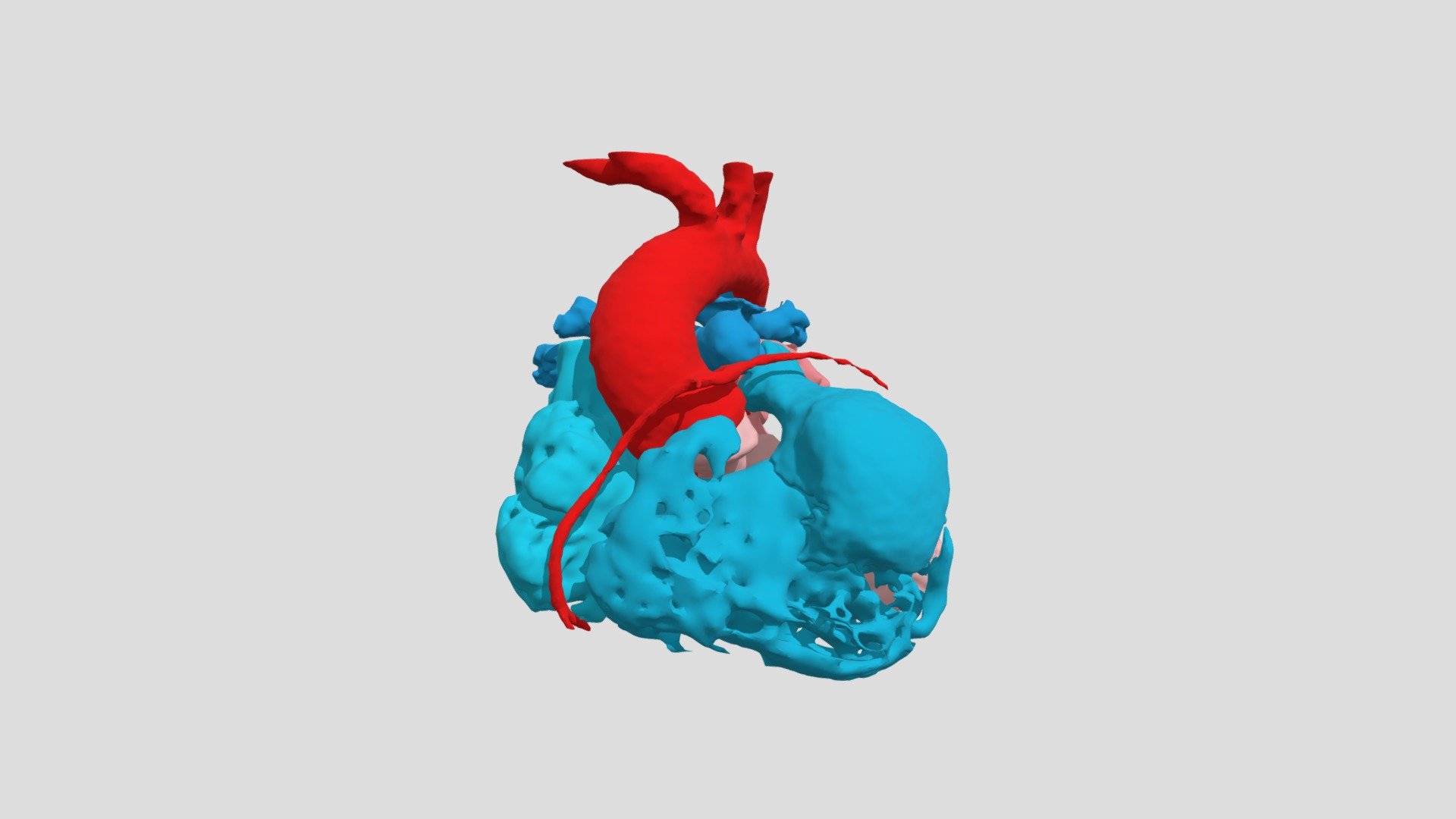 Tetralogy of Fallot, RVOT Obstruction (S0419) - 3D model by NCH ...