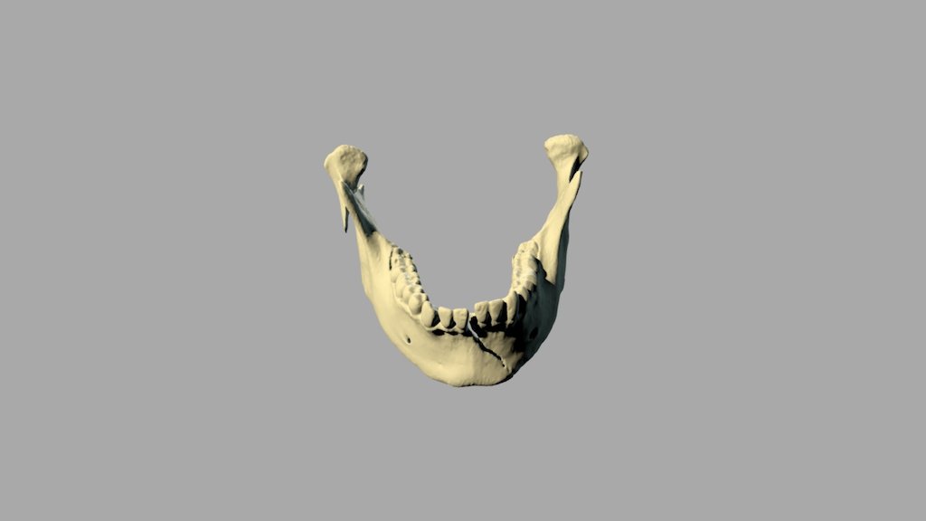 Mandible fracture: Condylar process - 3D model by FabStudMaster ...