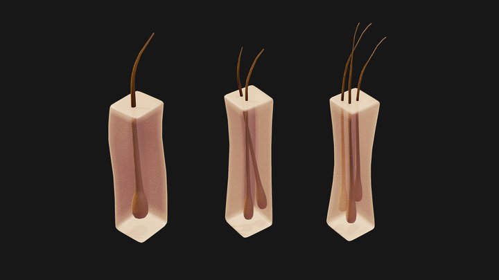 Hair_transplant 3D models - Sketchfab
