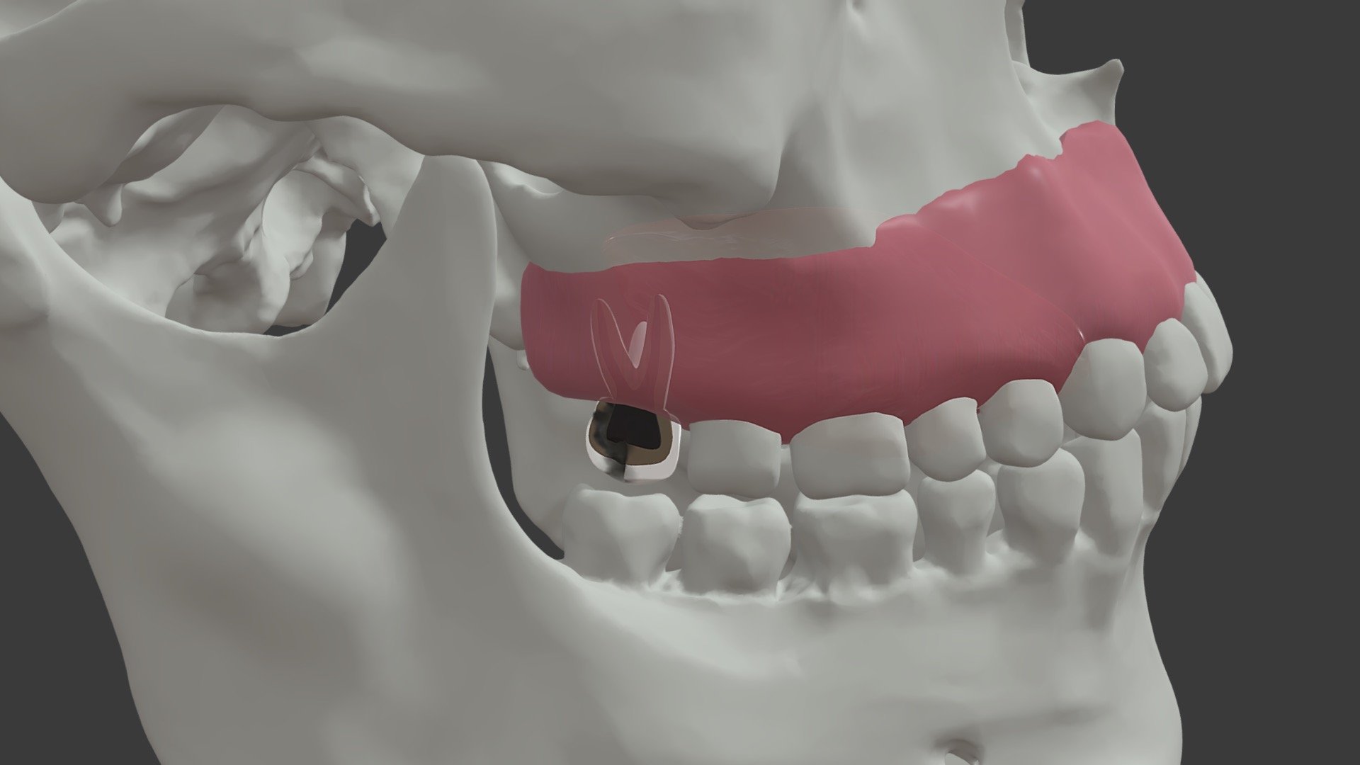 Stage 3 Short Root Maxillary Dental Infection - 3D model by University ...