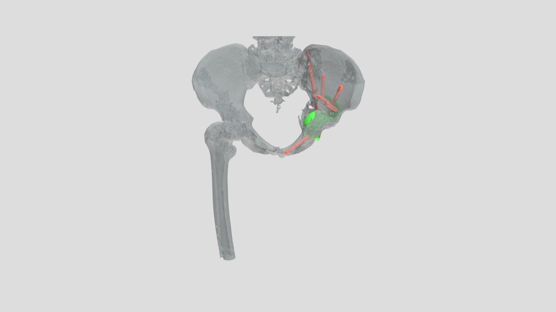 Implant_Acetabular_reinforcement_ring - 3D model by AnsreySin [f0f62ca ...