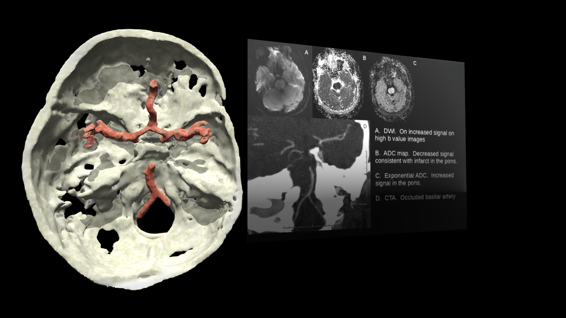 Pontine infarct with basilar artery occlusion - 3D model by tl0615 ...