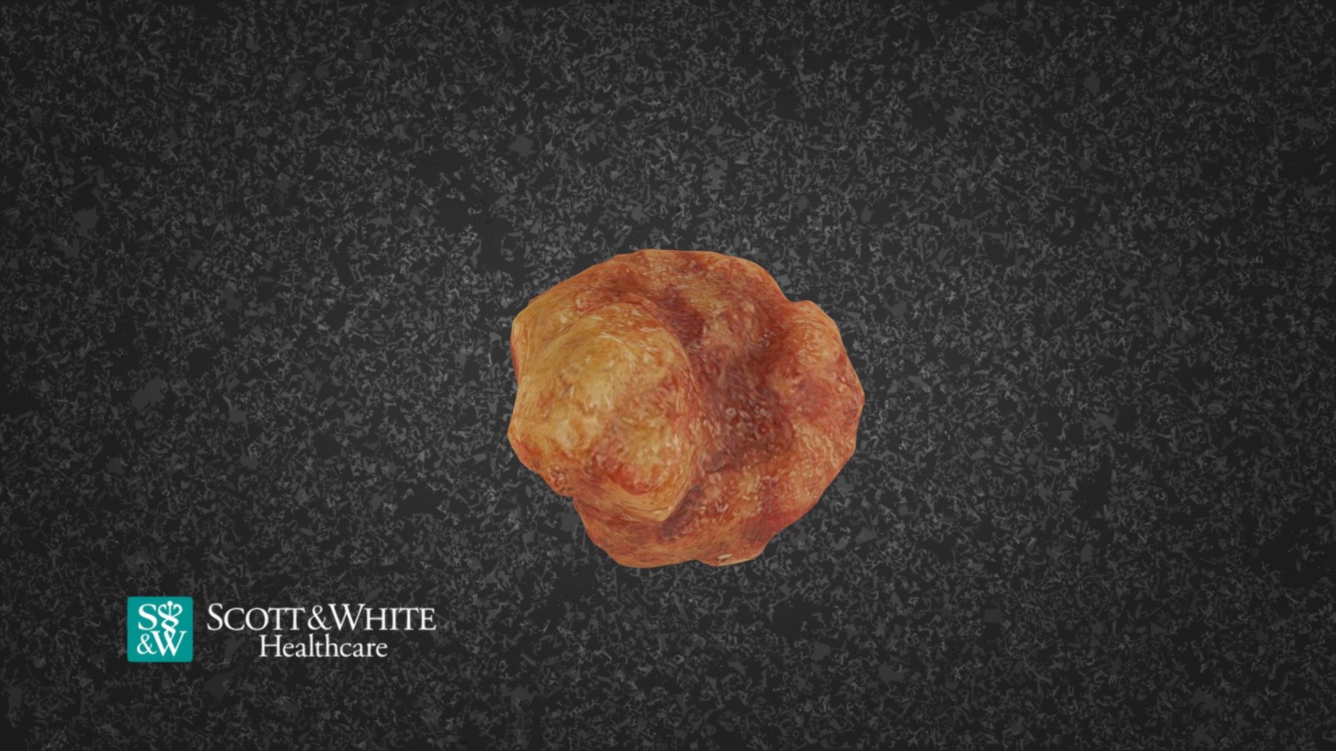 Bladder Tumor - Epithelioma 159669 - 3D model by Scott & White Moulage ...