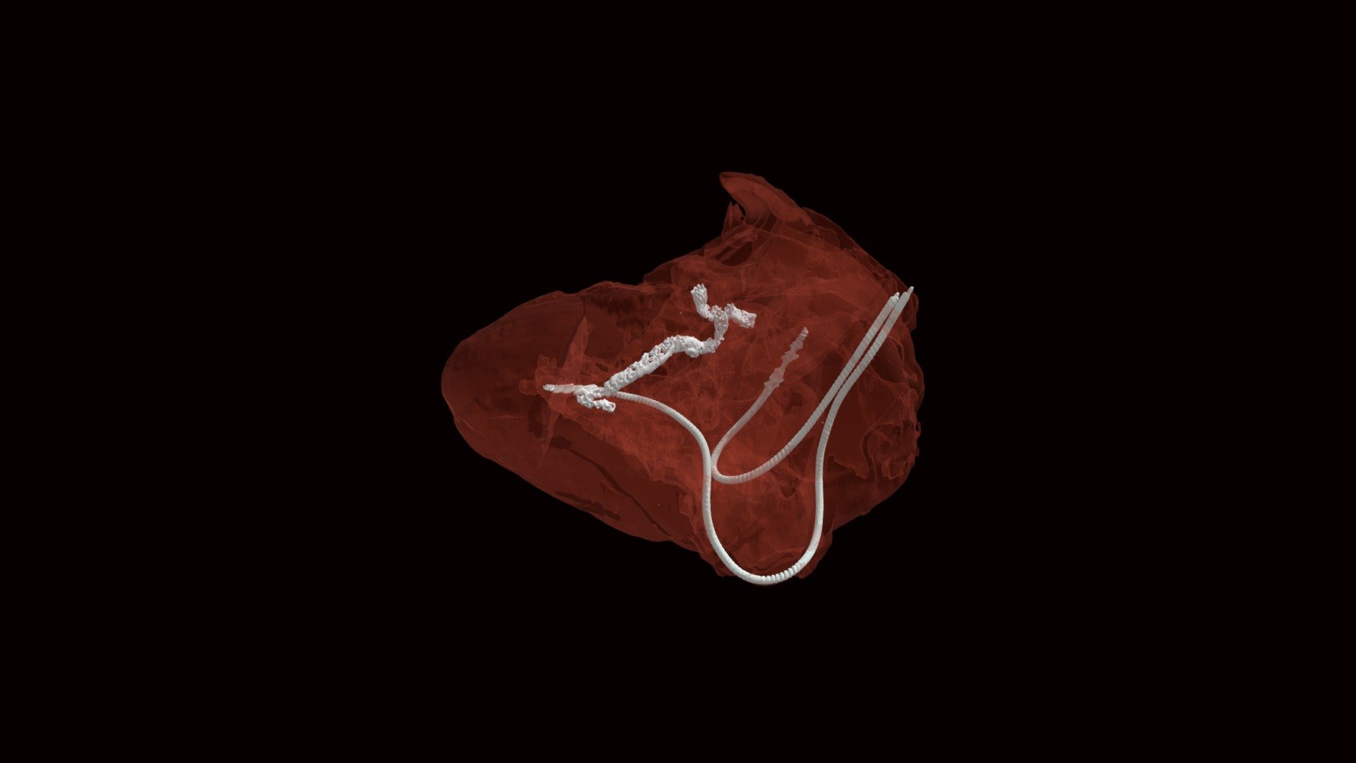 CC36621 Elderly Women with Pacemaker and Stents - Download Free 3D ...