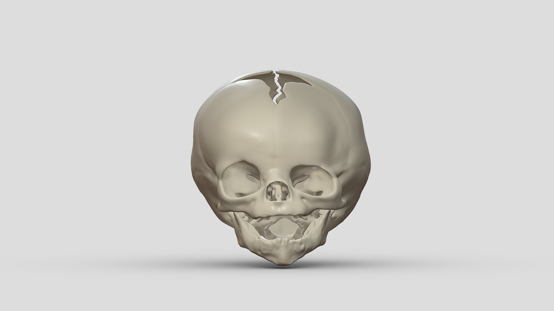 Left Frontosphenoidal Craniosynostosis - 3D model by Terrie Simmons ...