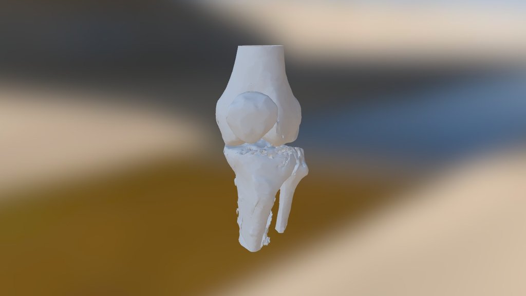 Knee - Proximal Tibia Fracture sku 025 - 3D model by orto3d [f31d6ee ...