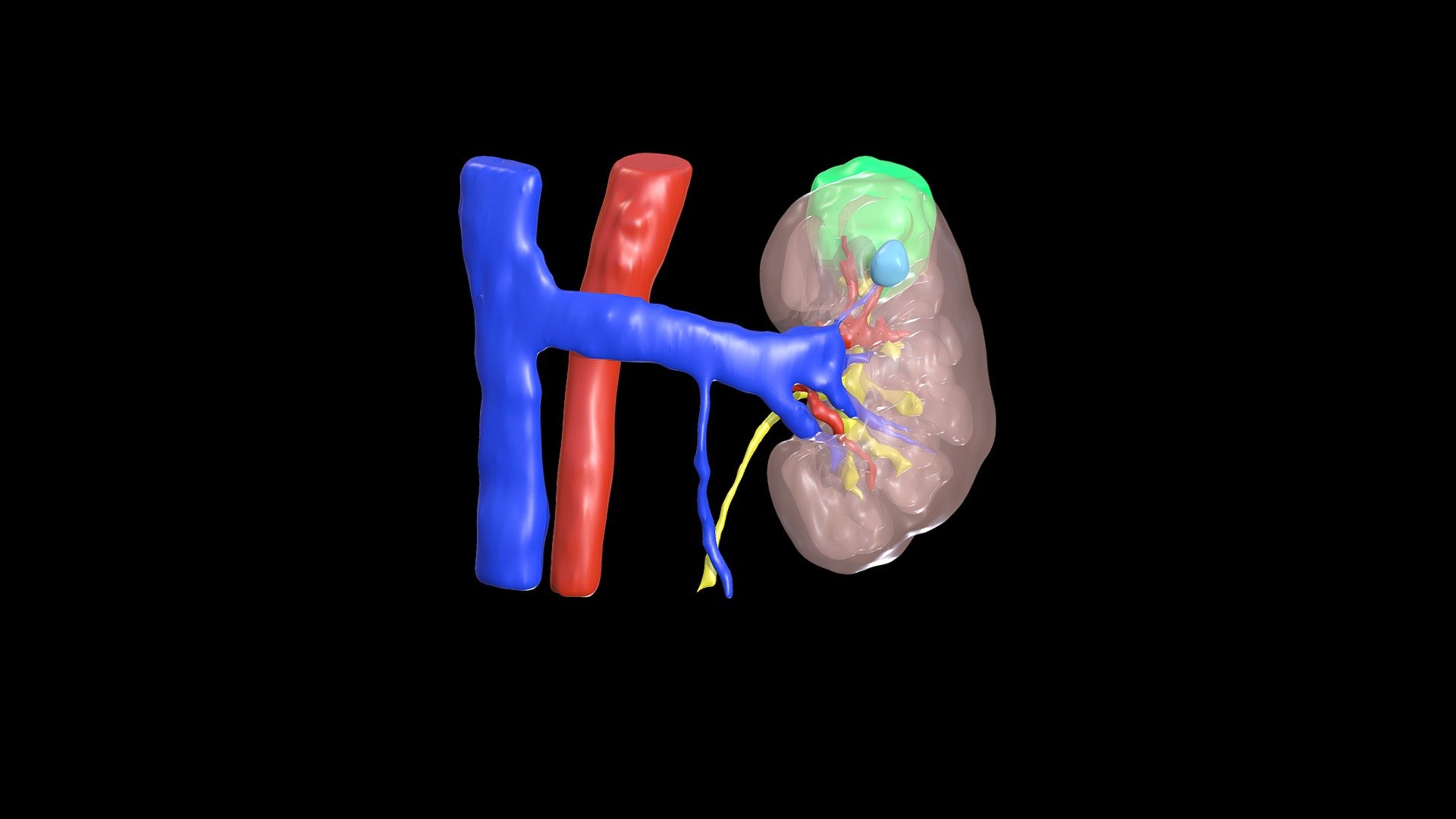 Left Renal Tumor - 3D model by Cirurgic3D (@neorenal) [f436cc2] - Sketchfab