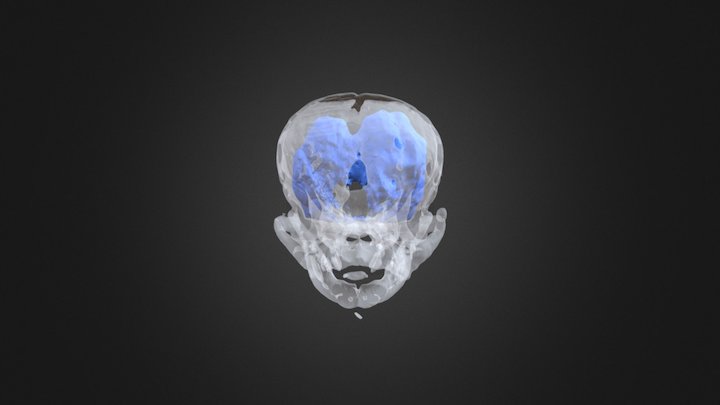 Hydrocephalus 3D models - Sketchfab