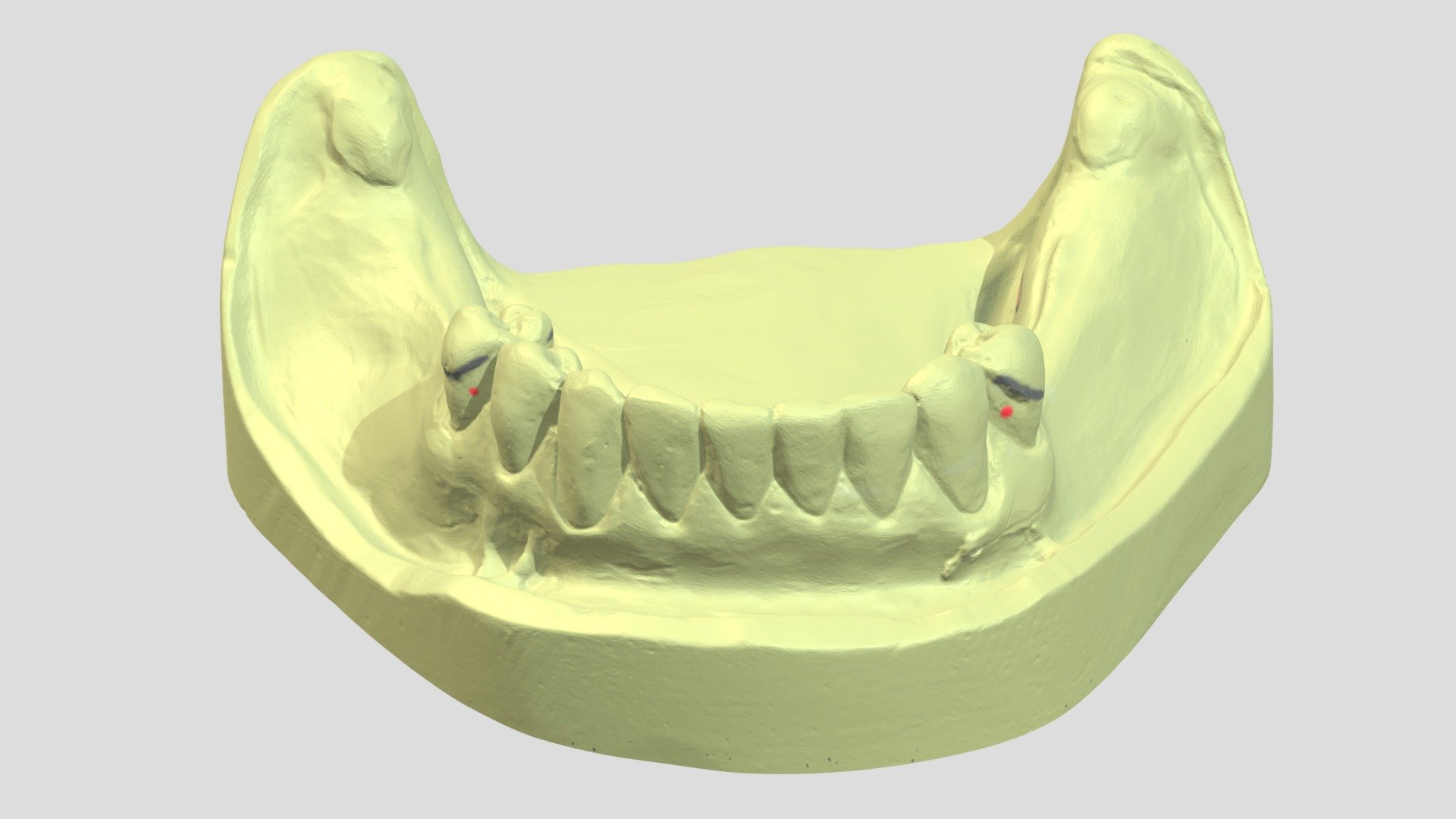 Class I Kennedy RPD Cast - 3D model by ramiammoun [f4670d6] - Sketchfab