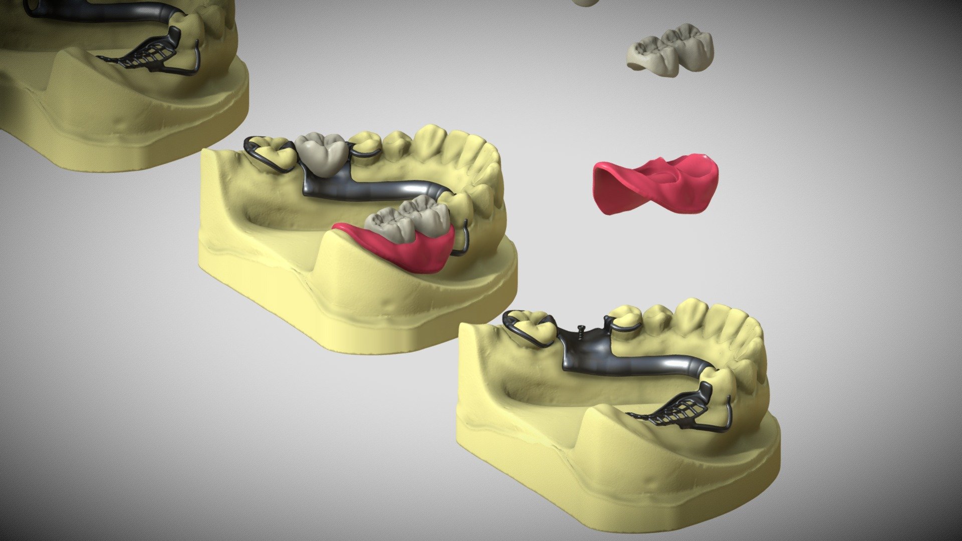 Kennedy Class Ii Mod 1 Design Mandibular 3d Model By Muhammad