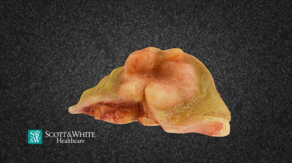 Colon- Carcinoma Of Sigmoid 1626673 - 3D model by Scott & White Moulage ...