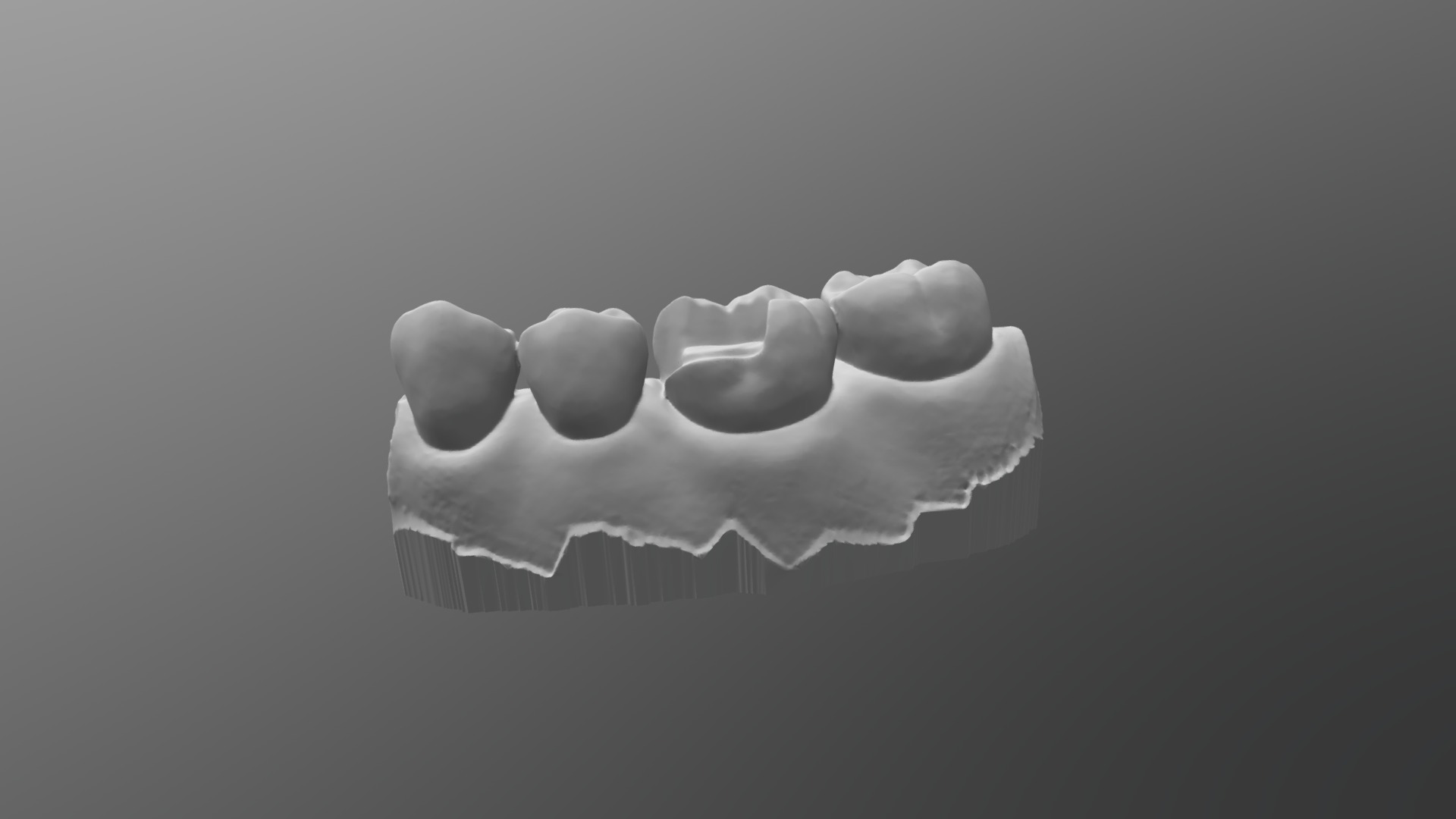 Onlay preparation - 3D model by Tony Mennito (@mennitoa) [f5ac6a4 ...