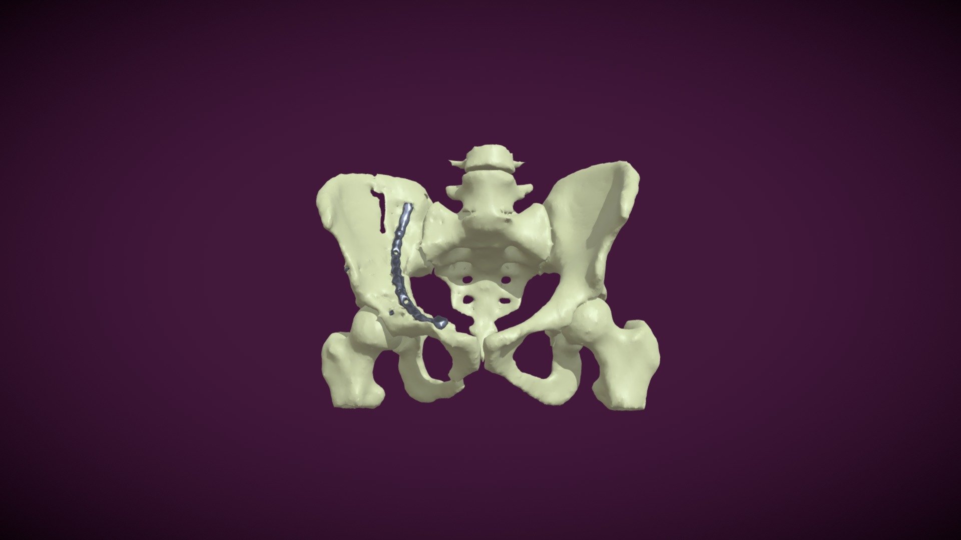Fractured Pelvis with Hardware - Download Free 3D model by CaitlynnH ...