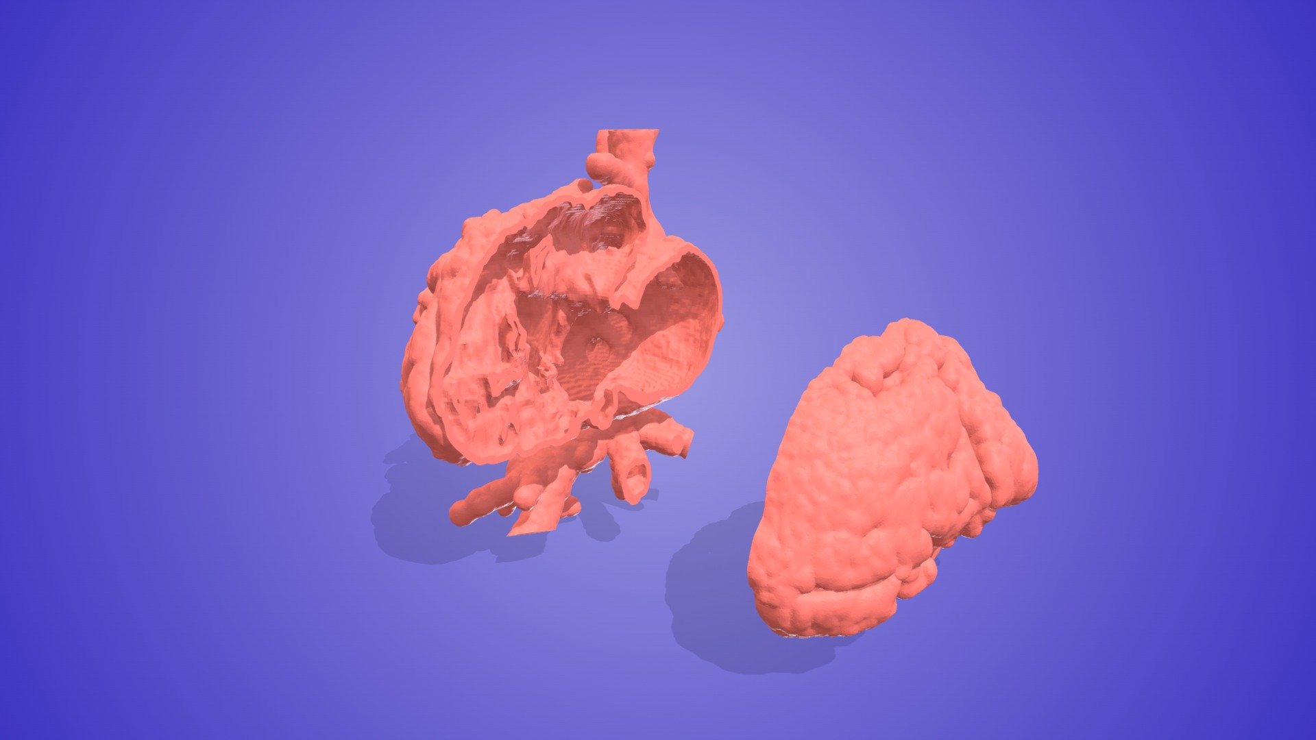 Left Atrial Isomerism - Download Free 3D model by 3D Heart Project ...