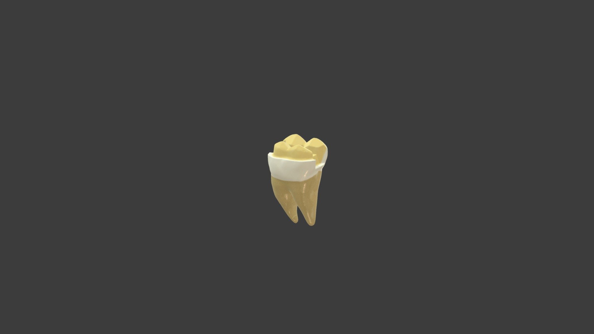 Gold Onlay - Preparation - 3D model by Ahmed Mahrous (@drahedmahrous ...