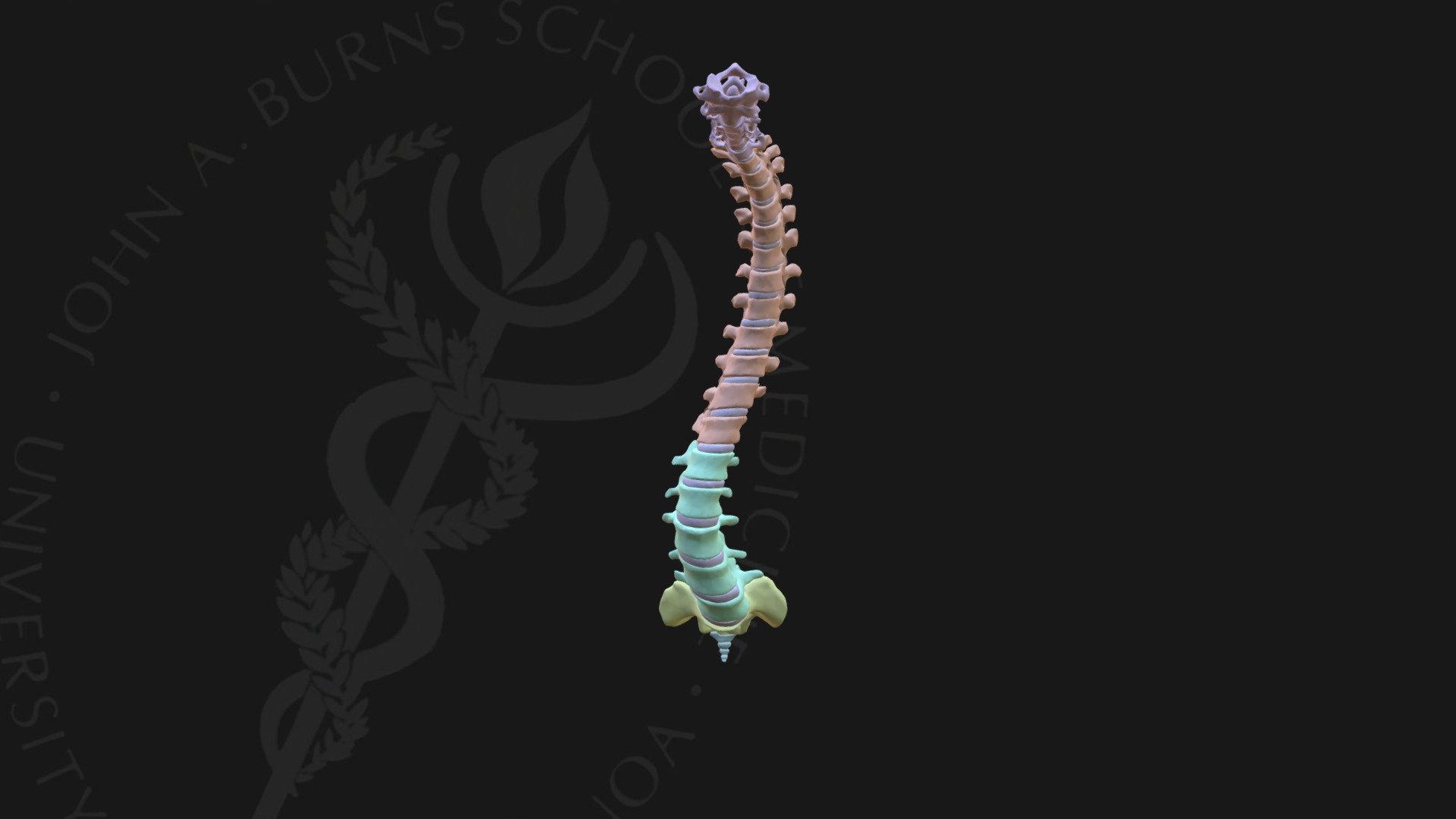 Scoliosis - 3D model by John A Burns School of Medicine (@jabsom ...
