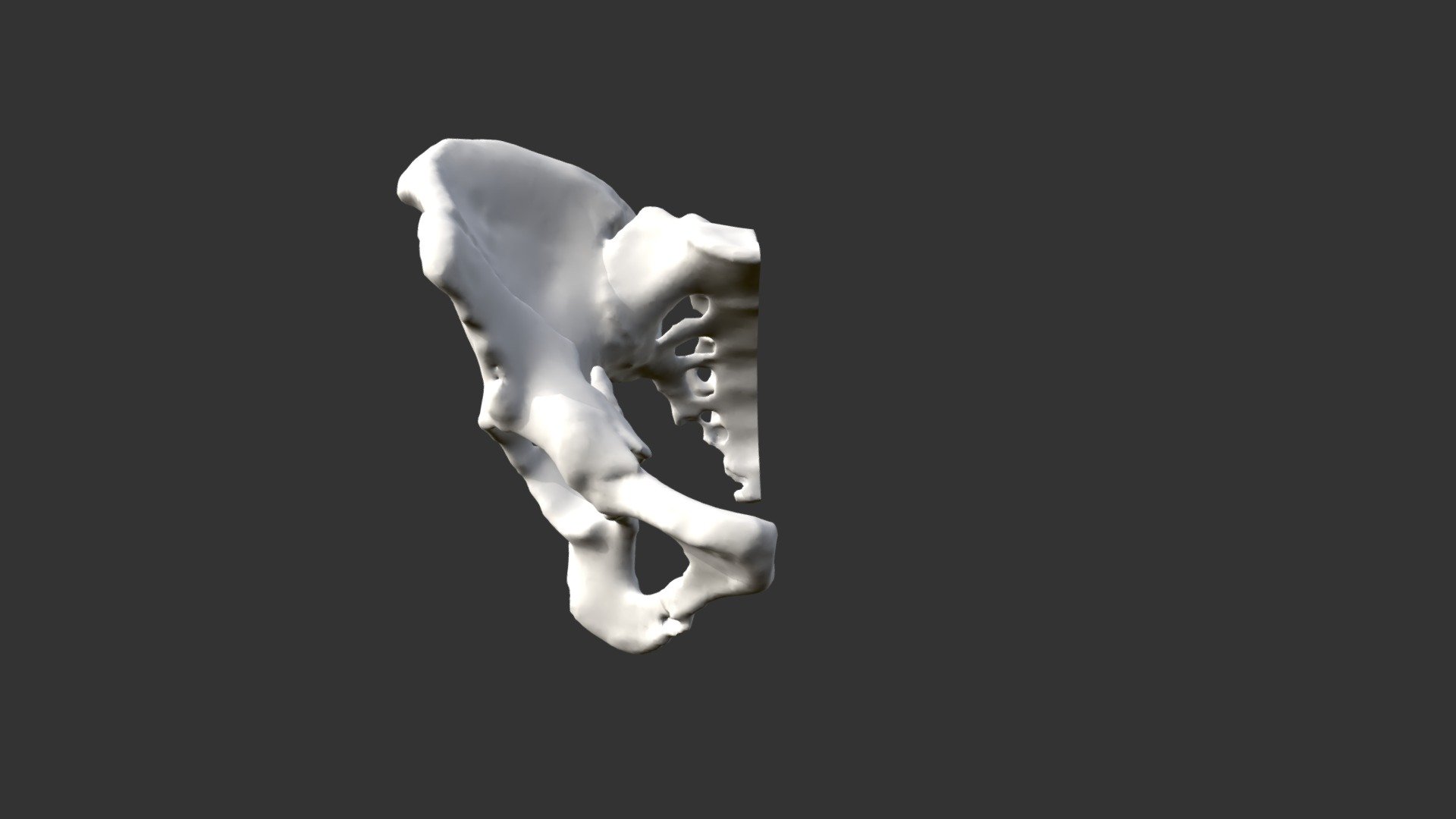 Pelvis Fracture - Both Column - 3D model by jgrayburn [f7a29ad] - Sketchfab